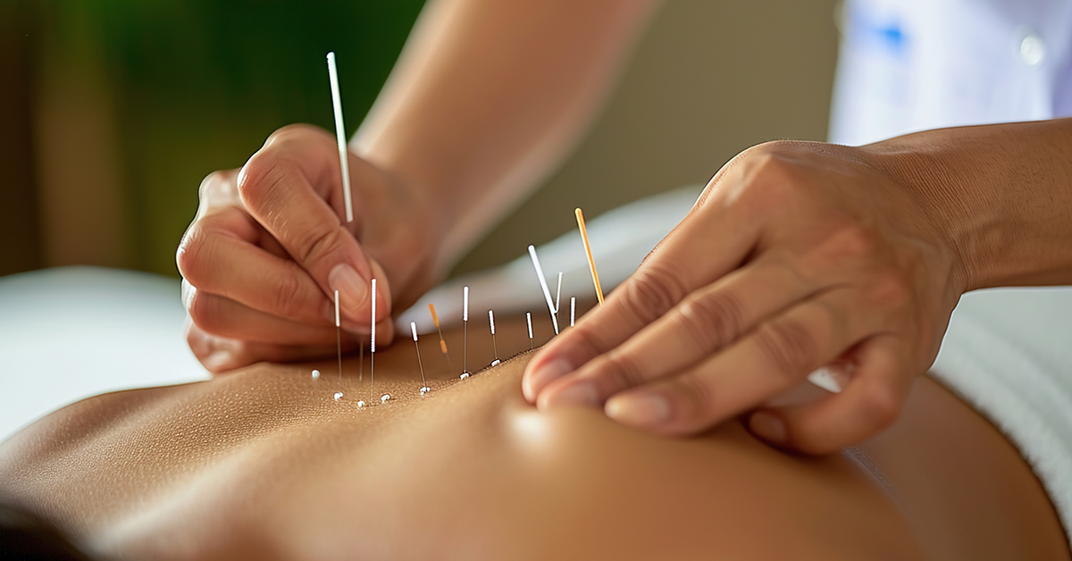 Acupuncture in Surrey: Your Complete Guide to Healing and Wellness - Beyond Physio Therapy